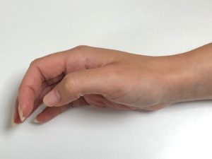 Hand Therapy - Carpometacarpal Joint Osteoarthritis - North Tees and ...