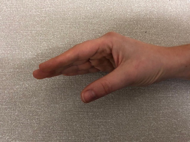 Hand Therapy - Carpometacarpal Joint Osteoarthritis - North Tees and ...