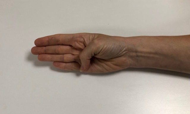 Hand Therapy - Carpometacarpal Joint Osteoarthritis - North Tees and ...