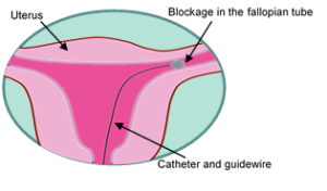 Fallopian Tube Recanalisation - North Tees and Hartlepool NHS ...