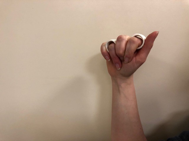 Hand Therapy - Exercises following extensor tendon finger repair. Zone ...