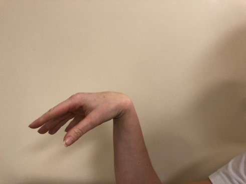 Hand Therapy - Exercises following extensor tendon finger repair. Zone ...