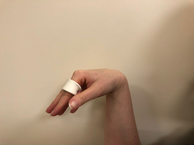 Hand Therapy - Exercises following extensor tendon finger repair. Zone ...