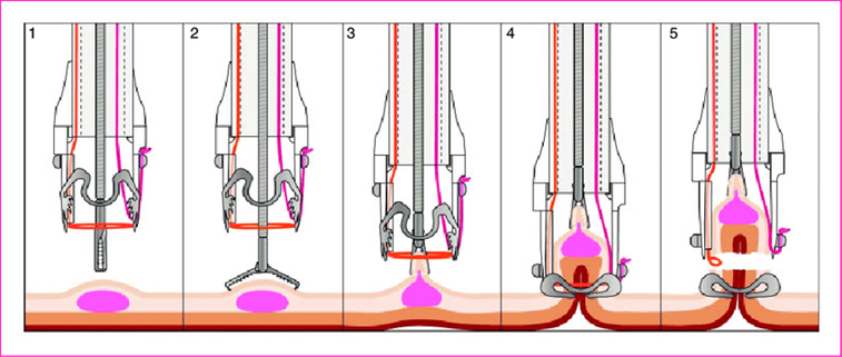 Endoscopic Full Thickness Resection (EFTR) - North Tees and Hartlepool ...