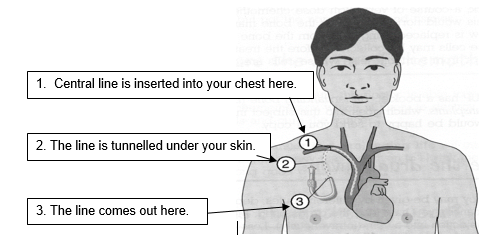 What is a Hickman Line? (Including care of the line). - North Tees and ...
