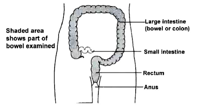 Computer Tomography (CT) Colonography - North Tees and Hartlepool NHS ...