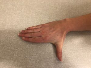Hand Therapy - Exercises following Extensor Pollicis Longus (EPL ...