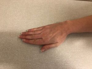 Hand Therapy - Exercises following Flexor Pollicis Longus (FPL) repair ...