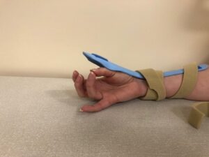 Hand Therapy - Exercises following Flexor Pollicis Longus (FPL) repair ...