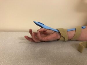 Hand Therapy - Exercises following Flexor Pollicis Longus (FPL) repair ...