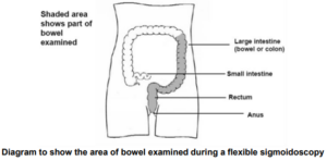Flexible Sigmoidoscopy - North Tees and Hartlepool NHS Foundation Trust