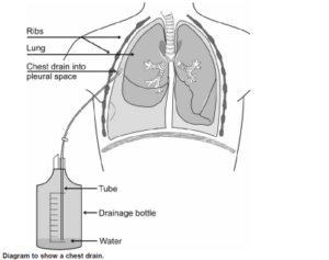 Insertion of a Chest Drain - North Tees and Hartlepool NHS Foundation Trust