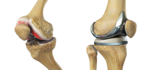 Knee Replacement - North Tees and Hartlepool NHS Foundation Trust