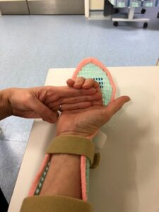 Hand Therapy - Exercises following Flexor Tendon Finger Repair - North ...