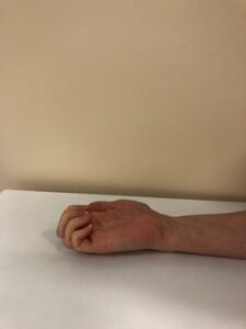 Hand Therapy - Exercises following Flexor Tendon Finger Repair - North ...