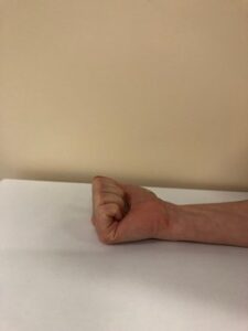 Hand Therapy - Exercises following Flexor Tendon Finger Repair - North ...