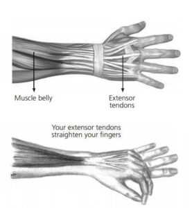 Hand Therapy - Extensor Tendon Finger Repair - North Tees and ...