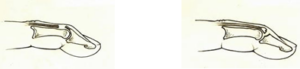Hand Therapy - Mallet Finger Injury - North Tees and Hartlepool NHS ...