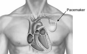 Permanent Pacemaker - North Tees and Hartlepool NHS Foundation Trust