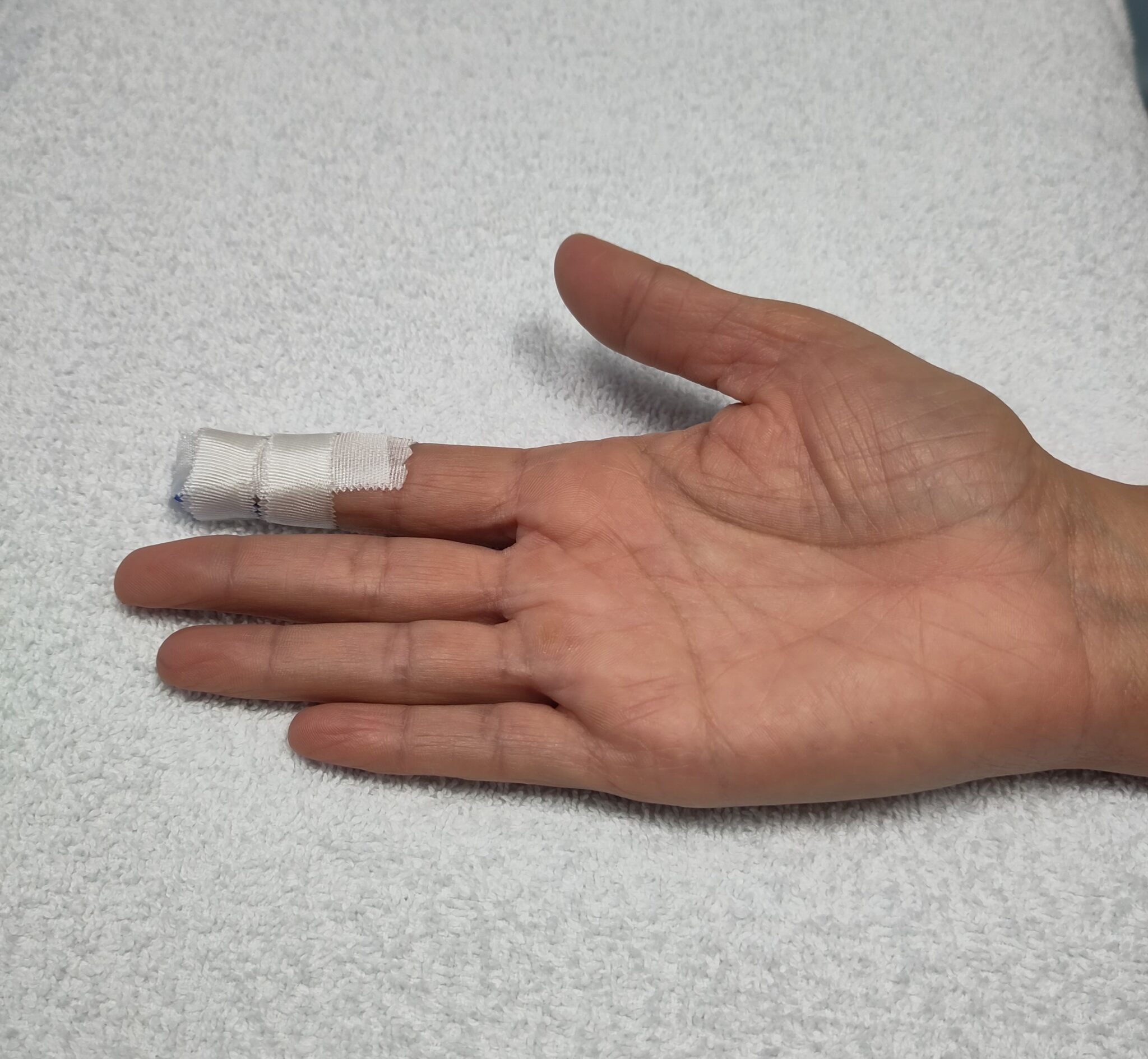 Hand Therapy - Exercises following Extensor Tendon Injury of the Finger ...