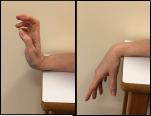 Hand Therapy - Exercises following ulna collateral ligament (UCL ...