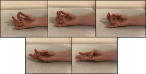 Hand Therapy - Exercises following ulna collateral ligament (UCL ...
