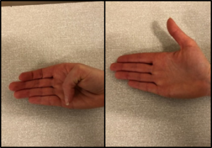 Hand Therapy - Exercises following ulna collateral ligament (UCL ...