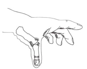 Hand Therapy - Thumb Ulnar Collateral Ligament (UCL) Repair - North ...