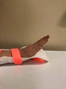 Hand Therapy - Exercises following Metacarpal Phalangeal Joint (MCPJ ...