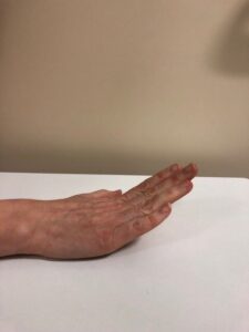 Hand Therapy - Exercises following Metacarpal Phalangeal Joint (MCPJ ...