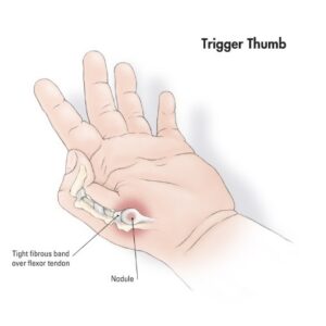 Hand Therapy - Trigger Thumb - North Tees and Hartlepool NHS Foundation ...