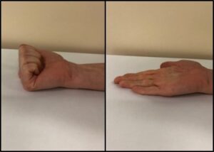Hand Therapy – Exercises following proximal interphalangeal joint (PIPJ ...