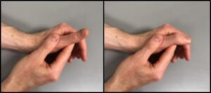 Hand Therapy - Trigger Thumb - North Tees and Hartlepool NHS Foundation ...