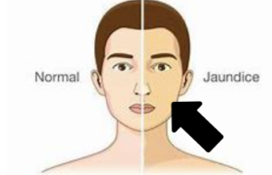 Paracetamol Safety for Adults - North Tees and Hartlepool NHS ...