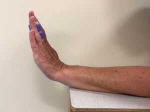 Hand Therapy - Exercises following Closed Central Slip - North Tees and ...